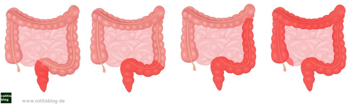 Proktitis bis Pancolitis: Was ist das? - colitisblog.de